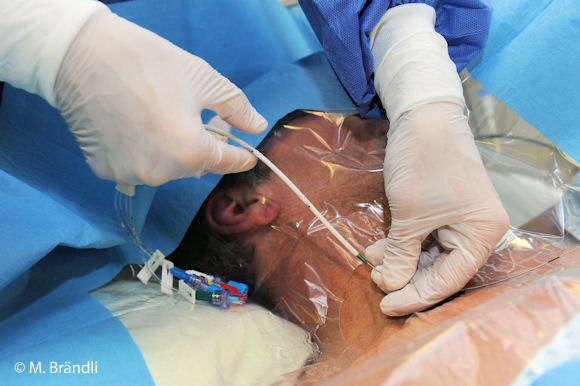 Zentraler Venenkatheter: ZVK-legen leicht gemacht | rettungsmagazin.de