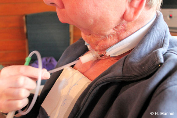 Tracheostoma absaugen: 5 Tipps für die Praxis | rettungsmagazin.de